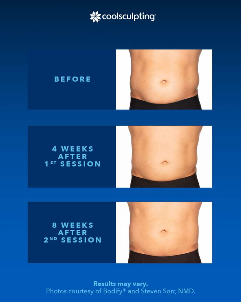 CoolSculpting Elite and CoolTone Facts - Premier Skin Clinic